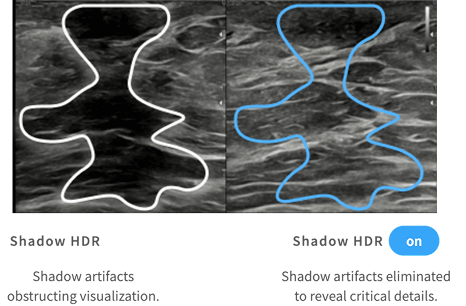 ShadowHDR Imaging Ultrasound Tech | Samsung Healthcare