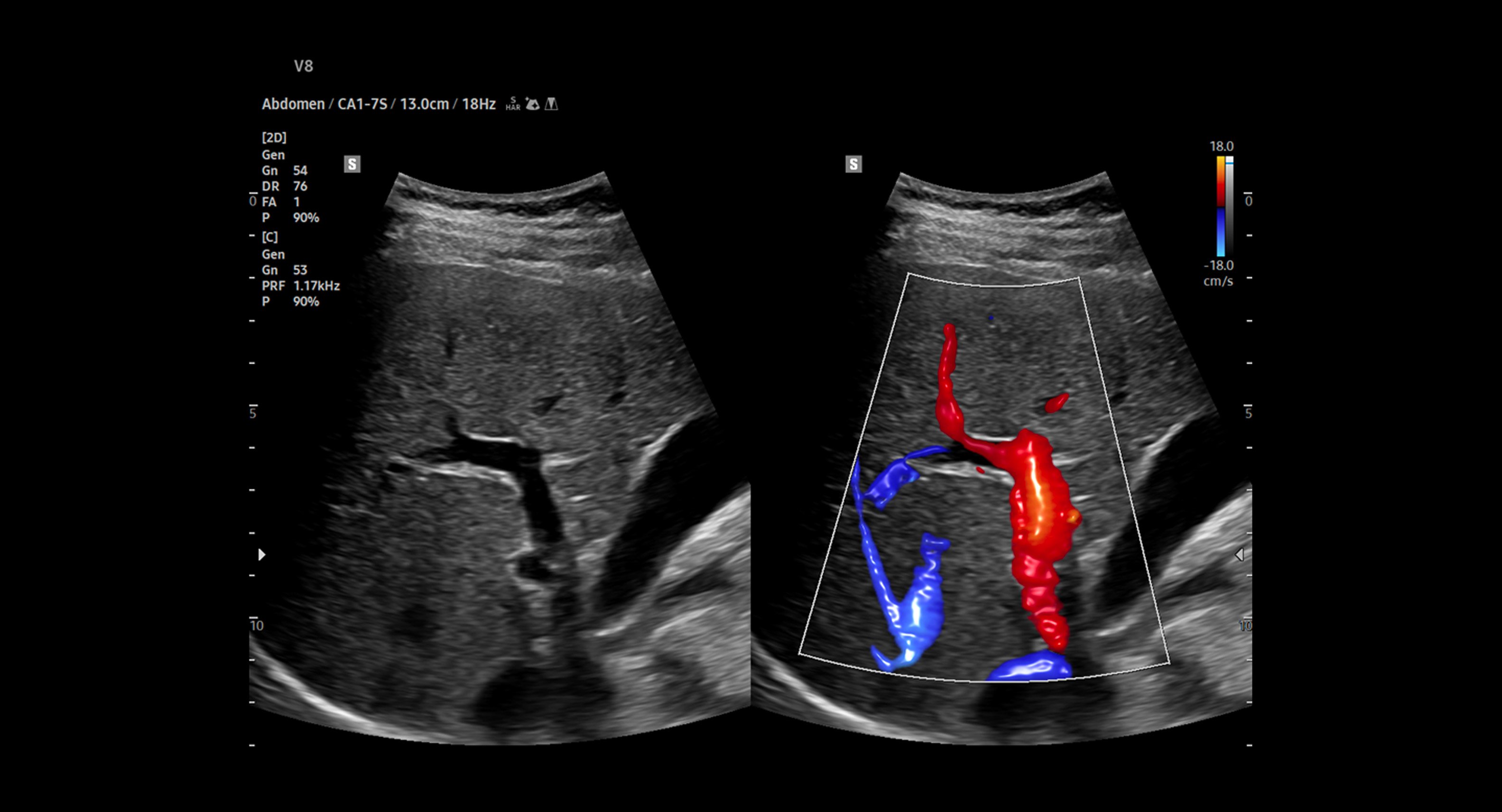 Intestinal IBD Bowel POC Ultrasound | Samsung Healthcare