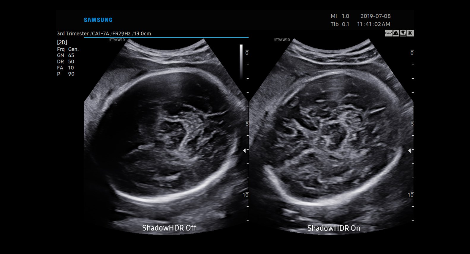 Samsung V8 General Imaging Ultrasound | Samsung Healthcare