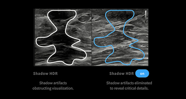 ShadowHDR Imaging Ultrasound Tech | Samsung Healthcare